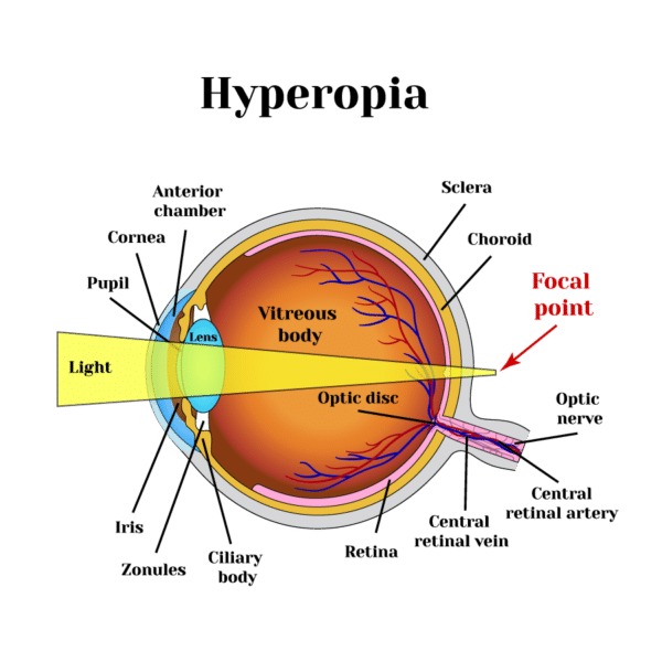 Hyperopia: Symptoms, Diagnosis and Treatment